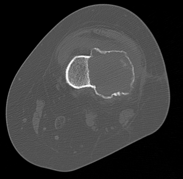 Giant Cell Tumour of Bone | The Bone School